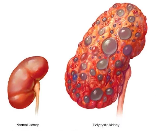 7 signs that show your kidney is not working properly
